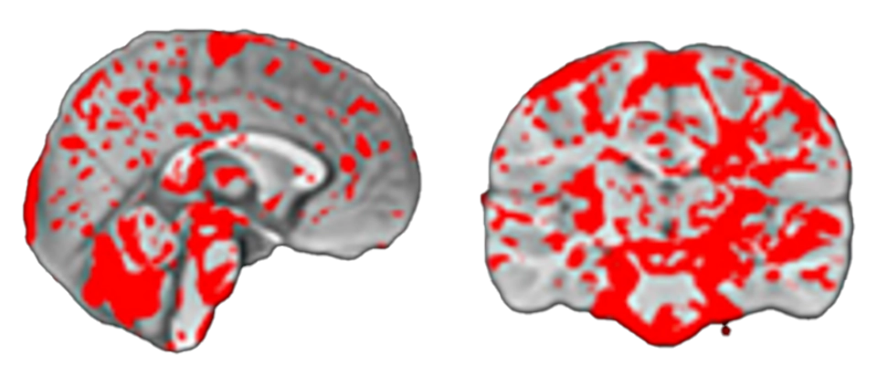 Brain development mfgm study