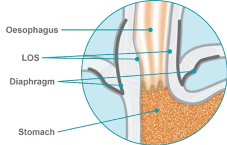 HCPWEB Article: GI Infant